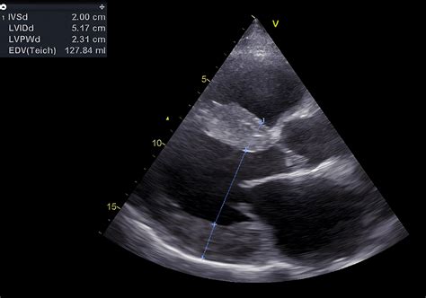 Specific Cardiomyopathies Medical Pathway