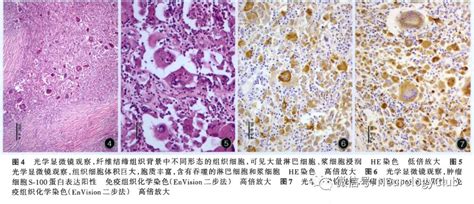 朗格汉斯巨细胞形态朗格汉斯巨细胞朗格汉斯巨细胞图片第9页大山谷图库