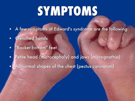 Edwards Syndrome By Breyana Moore Davis