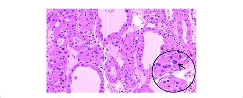 Oncocytic Follicular Variant Papillary Thyroid Carcinoma These Download Scientific Diagram
