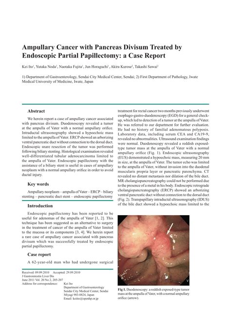 Pdf Ampullary Cancer With Pancreas Divisum Treated By Endoscopic