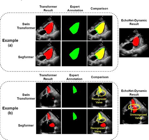 Figure 6 From Left Ventricle Segmentation In Echocardiography With Transformer Semantic Scholar