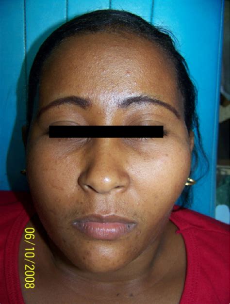 Figure 1 From Unusual Solitary Osteoma Coronoid Process And Aesthetic