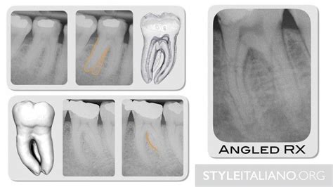 Radix Entomolaris Case Series And Clinical Considerations Style