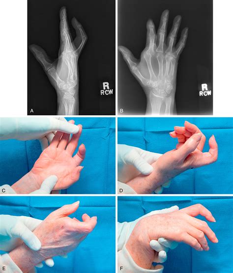 Metacarpophalangeal Joint Dislocations Clinical Tree