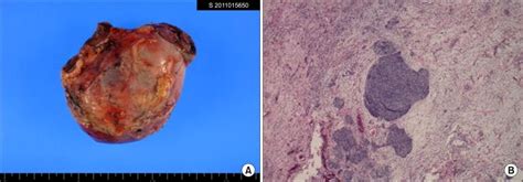 Histopathological Findings A Grossly The Excised Mass Originated