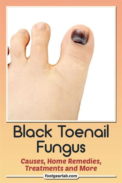 How To Treat A Black Toenail Causes Treatments Artofit