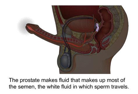 Prostate Cancer External Beam Radiation