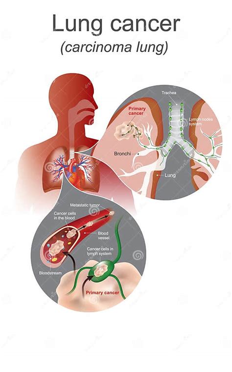 El Cáncer De Pulmón Es Un Tumor Malo Del Pulmón Caracterizado Por El Uncon Stock de ilustración ...