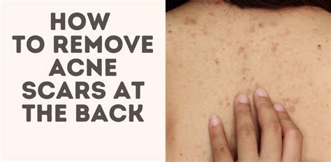 How To Remove Acne Scars At The Back Treat Your Scars
