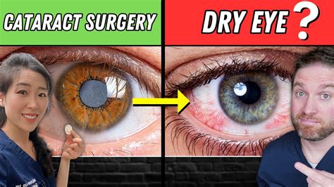 Dry Eyes After Cataract Surgery Causes And Tips To Help Youtube