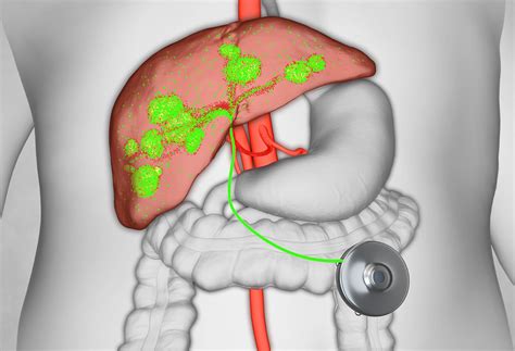 Hepatic Artery