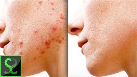 How To Remove Acne Pimples In Photoshop Photoshop Tutorial Youtube