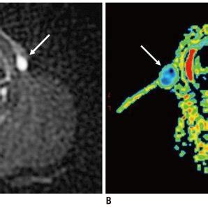 Appearance Of Conventional MRI Diffusion Weighted Imaging And Apparent