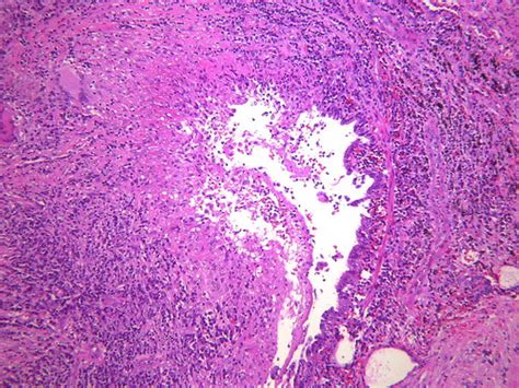 Bronchocentric Granulomatosis Case 146 Necrotizing Granulo Flickr