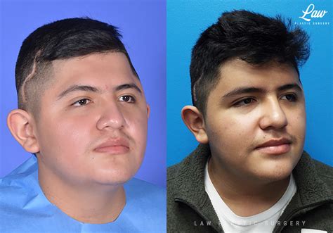 Craniosynostosis Before And After Photos Sage Plastic Surgery