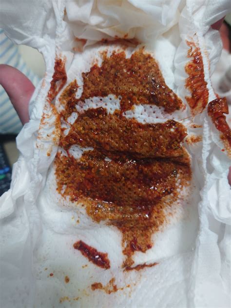 血便？【赤ちゃんの病気・ケガ】｜ベビーカレンダー専門家相談