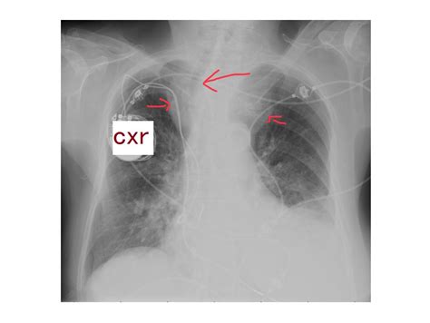 Imaging Case Of The Week 511 Answer Emergucate