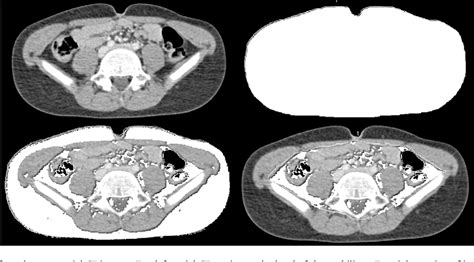 Table 1 From Nutcracker And Sma Syndromes What Is The Normal Sma Angle