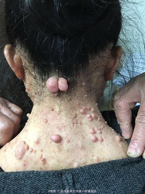 神经纤维瘤一例