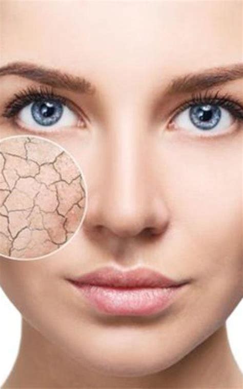 Dry Skin Xerosis Revitalis