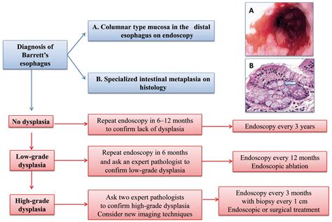 Barretts Esophagus And Esophageal Cancer An Overview