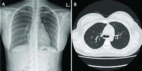 A Chest Radiograph And B Chest Computed Tomography Showing