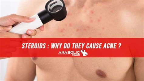 Steroids And Acne Why Do They Cause Acne Anabolic Coach
