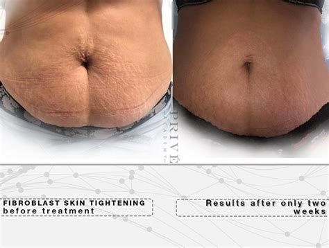 Fibroblast Skin Tightening Services In St Clair Shores Michigan