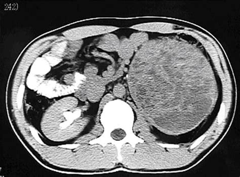 Computerized Tomography Shows A Heterogeneous Mass Originating From The