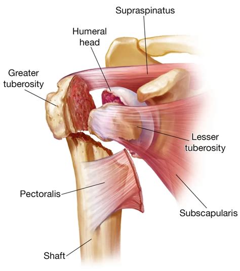 Proximal Humerus Fracture Don T Ignore A Broken Shoulder