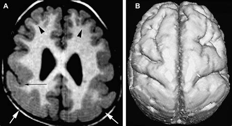 Development And Dysgenesis Of The Cerebral Cortex Malformations Of Cortical Development