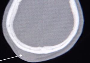 Scalp Mass CT Scan Dr Barry Eppley Indianapolis Explore Plastic Surgery