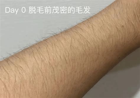 烦！屁屁缝里为啥会长毛？能脱吗？脱毛私处皮肤