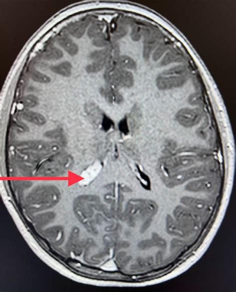 Spin Academics On Linkedin Tip Of The Day 💡 An Enlarged Choroid