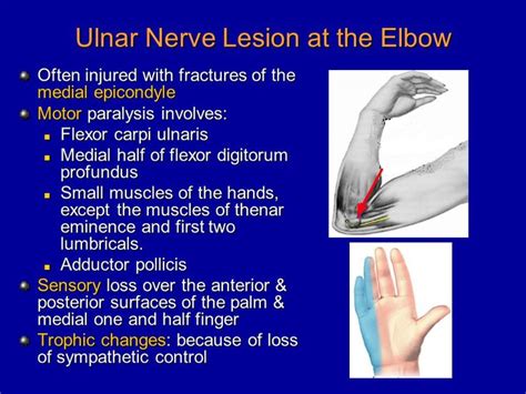 Ulnar Nerve Compression Charterjery