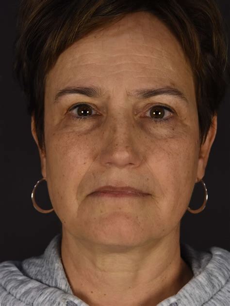 Lower Eyelids With Browlift