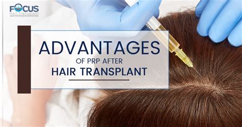 Benefits Of PRP After Hair Transplant