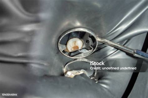 자료 작성으로 인간의 치아의 모 랄의 복원 치과에서 미적 원기를 회복 시키는 치과의 개념 개체 그룹에 대한 스톡 사진 및 기타 이미지 개체 그룹 건강관리와 의술 구멍