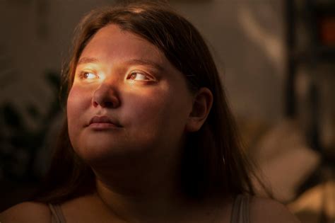 Protect Your Vision How To Prevent And Treat Sunburned Eyes