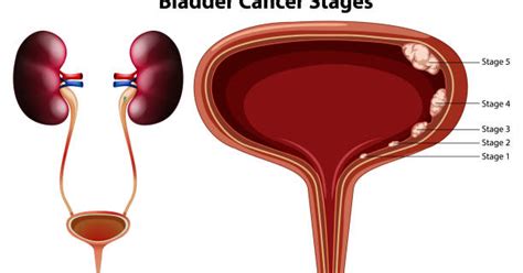 All You Need To Know About Bladder Cancer