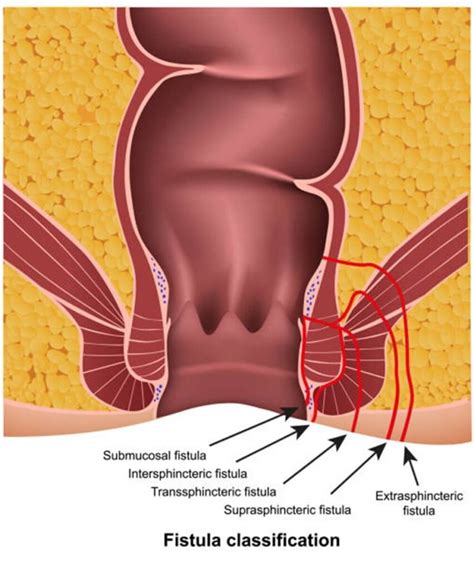 Anal Fistula Naalvran Shreeja Homeo Clinic