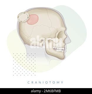 Craniotomy Surgery Bone Flap Removal Stock Illustration As Eps 10