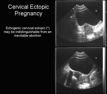 Ultrasound In Ectopic Pregnancy
