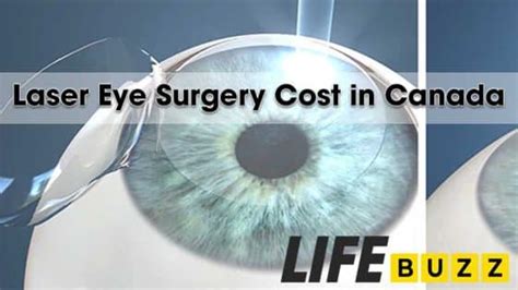 Laser Eye Surgery Cost In Canada Does Insurance Cover