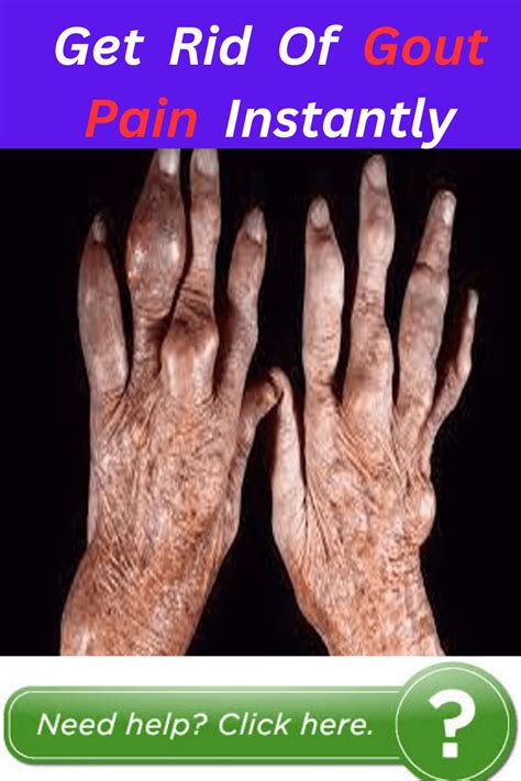 What Is The Fastest Way To Get Rid Of Gout Artofit