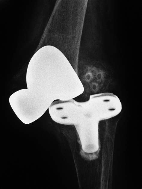 Medical Apparatus Imaging Guide Joint Arthroplasty
