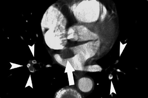 Acute Segmental Pulmonary Embolism And Incidental Demonstration Of