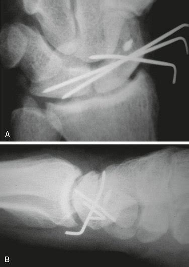 Dorsal Capsulodesis Clinical Gate