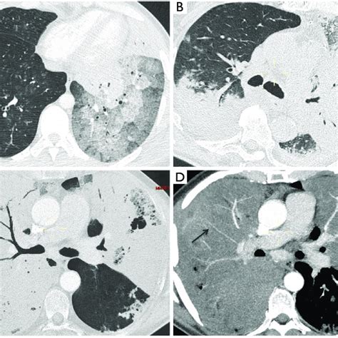 Pdf Diagnosis And Prognosis Of Acute Respiratory Distress Syndrome